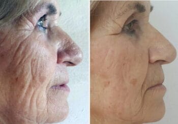 Neofound Skin Rejuvenation - Teleta Pharma