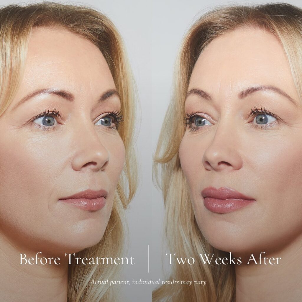 The world’s first OxiFree Dermal Filler – MaiLi - Teleta Pharma