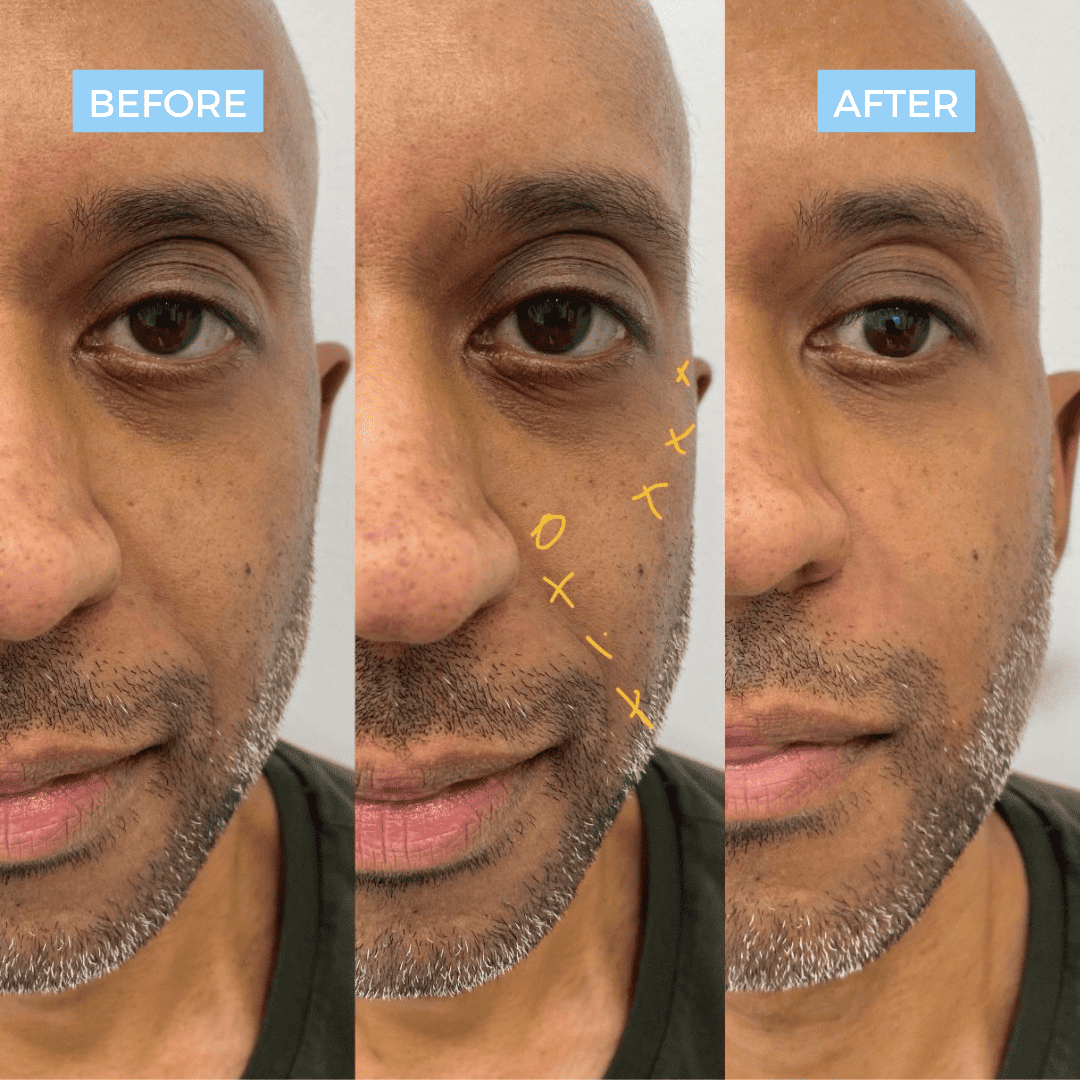 UPHA Filler (1ml, 2ml & 10ml) - Teleta Pharma