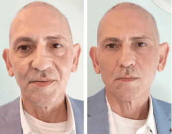 UPHA Filler 1ml - Teleta Pharma